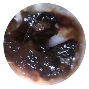 Evaluación y limpieza de oídos – CEFES